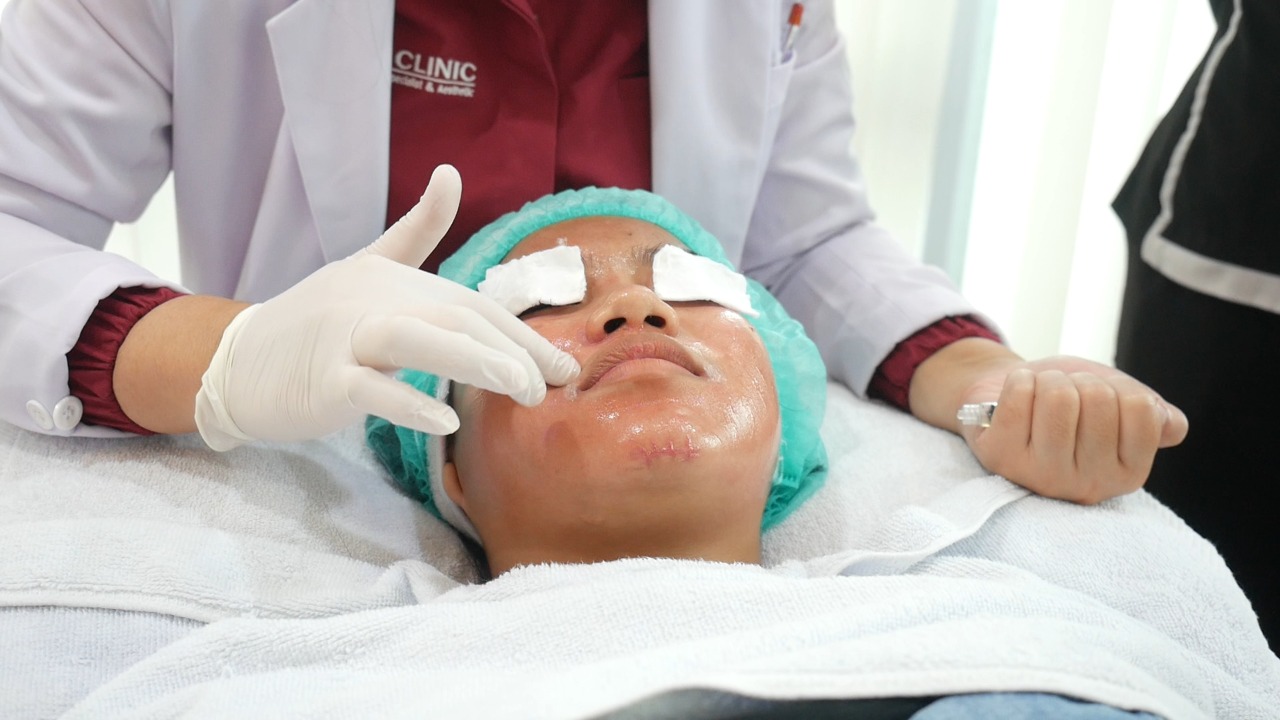 Tips Merawat Kulit Tipe Normal – Acne Scar & Face Contouring Clinic